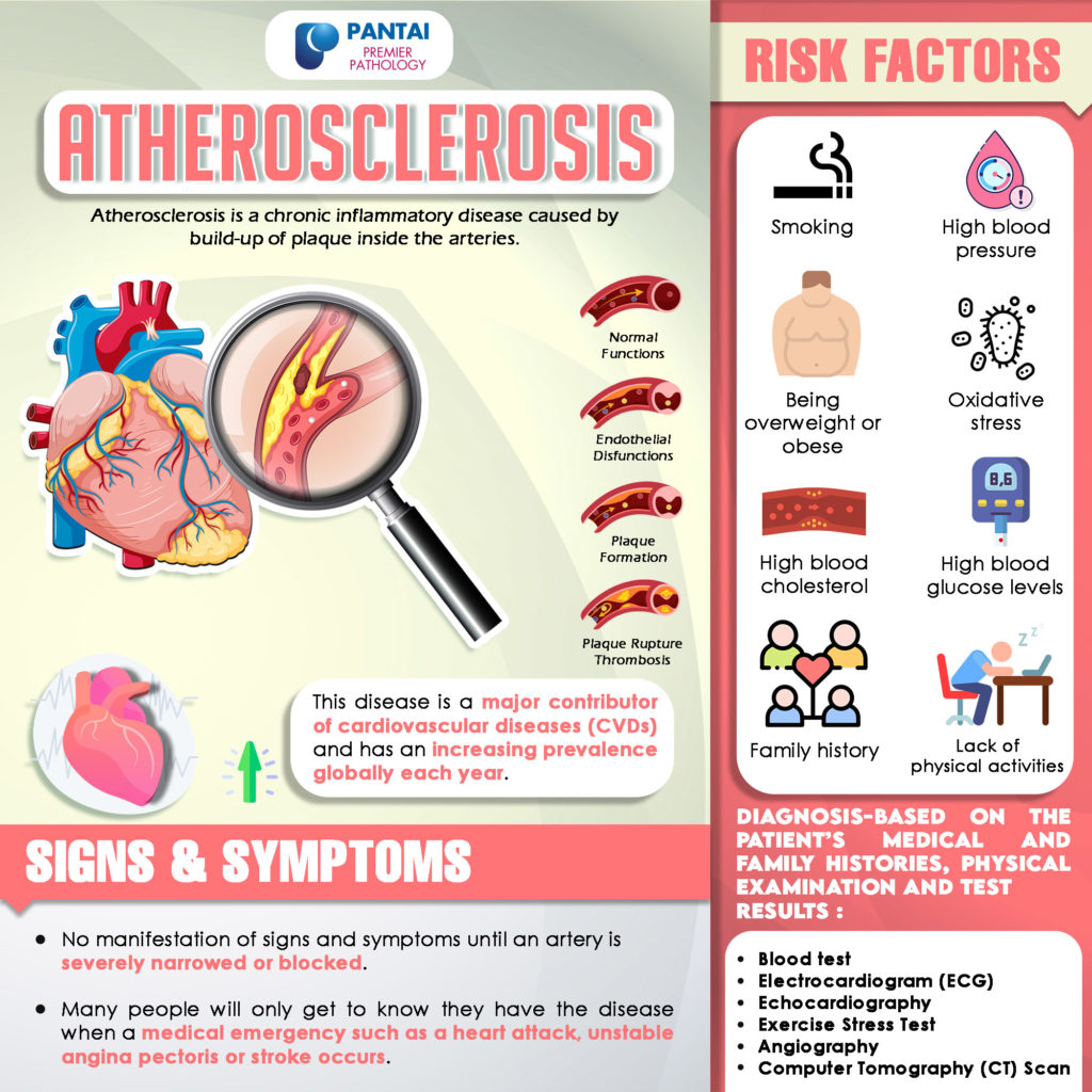 What is Atherosclerosis and how it can contribute to heart disease ...